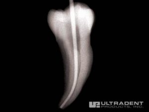 EndoREZ Canel Sealer - NUDENT