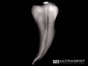 EndoREZ Canel Sealer - NUDENT