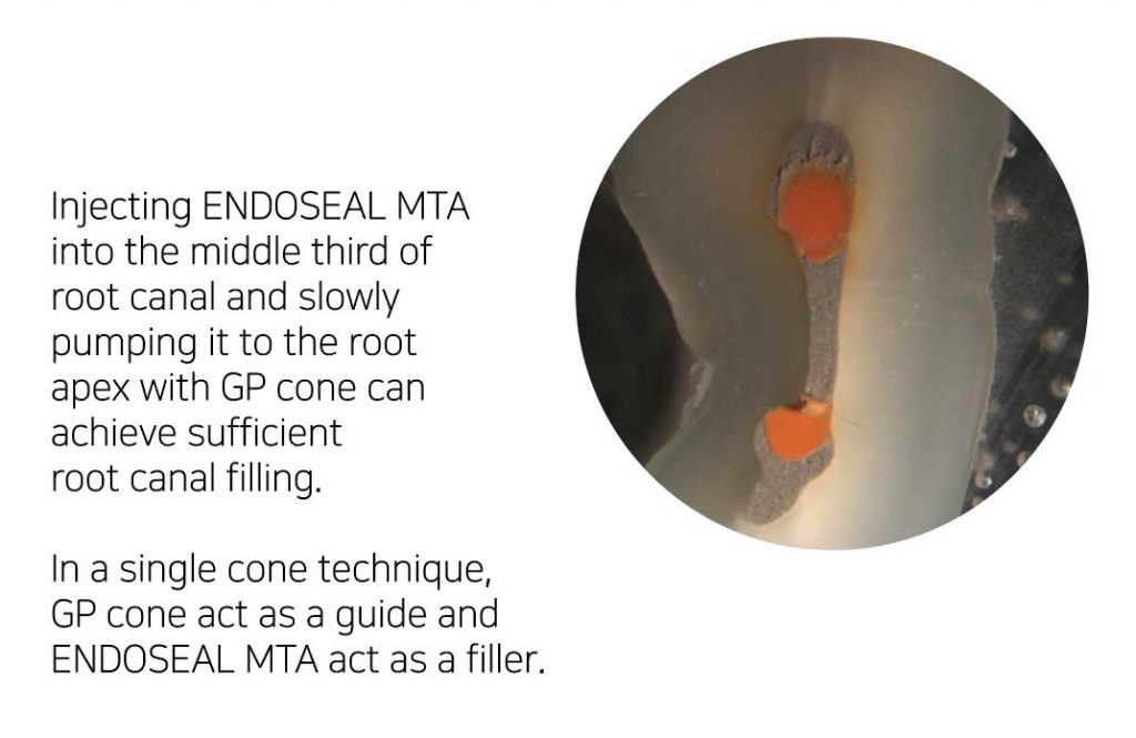 Endoseal MTA - NUDENT